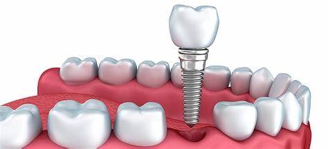 7 Risk factors behind the breakdown of tooth implants