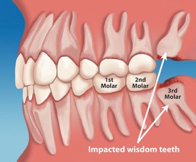 What you should know about Wisdom Teeth Extraction?