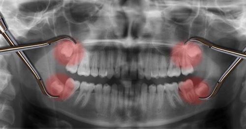 What you should know about Wisdom Teeth Extraction?